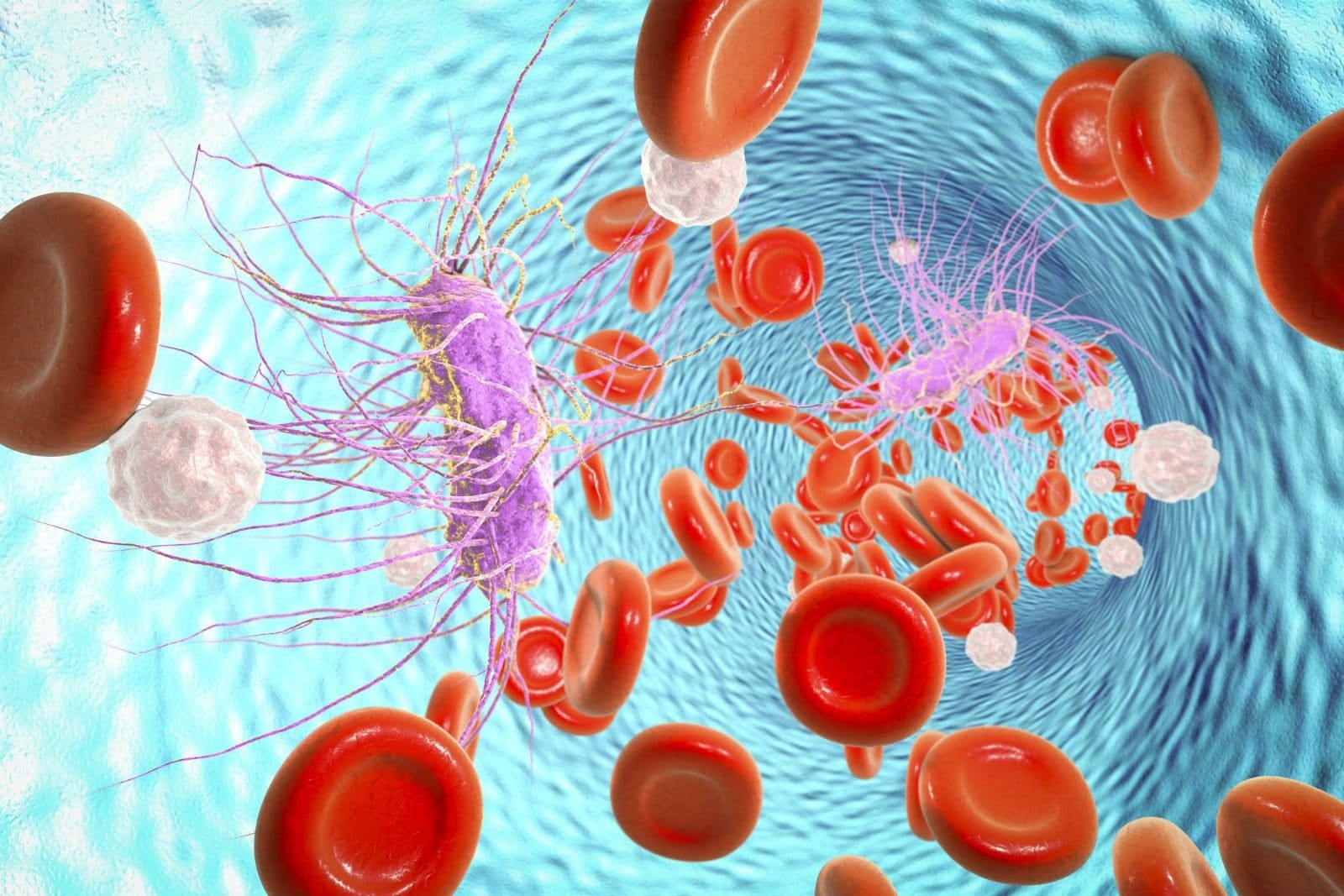 FDA Approves AI Tool for Sepsis Detection - Extract Systems